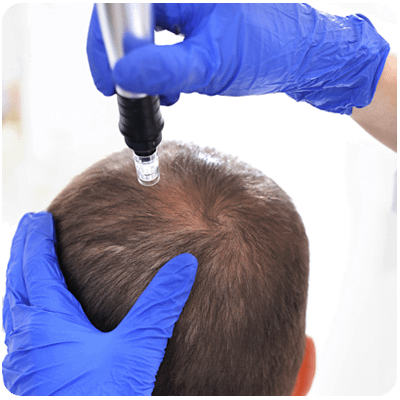 Scalp Micro Needling For Hair Loss | Unique Cosmetology